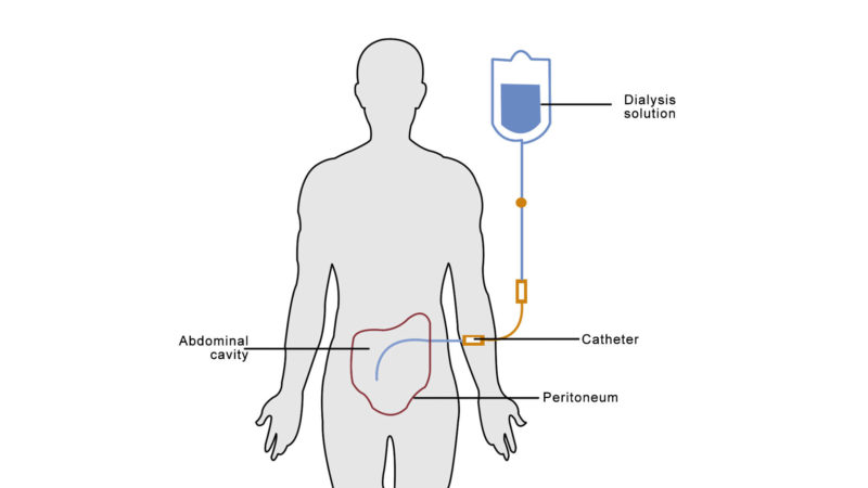 Peritoneal Dialysis – NutritionFact.in