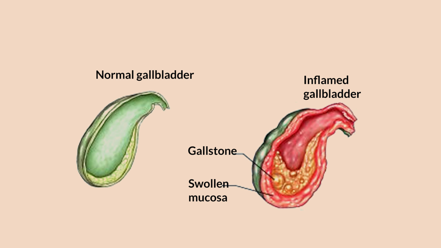 Cholecystitis – Diagnosis, Treatment and Prevention – NutritionFact.in