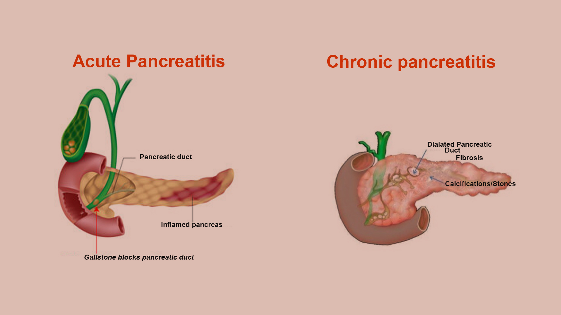 Pancreatitis Types Symptoms NutritionFact in Pancreatitis Types Symptoms NutritionFact in