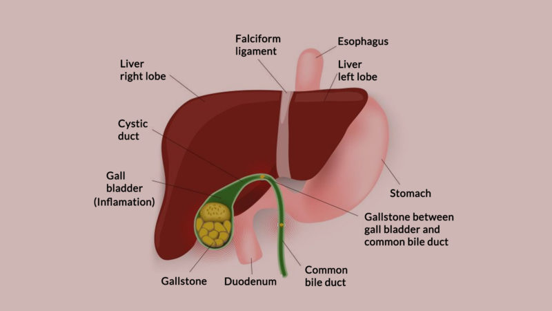 Cholecystitis – Symptoms, Causes and Complications – NutritionFact.in