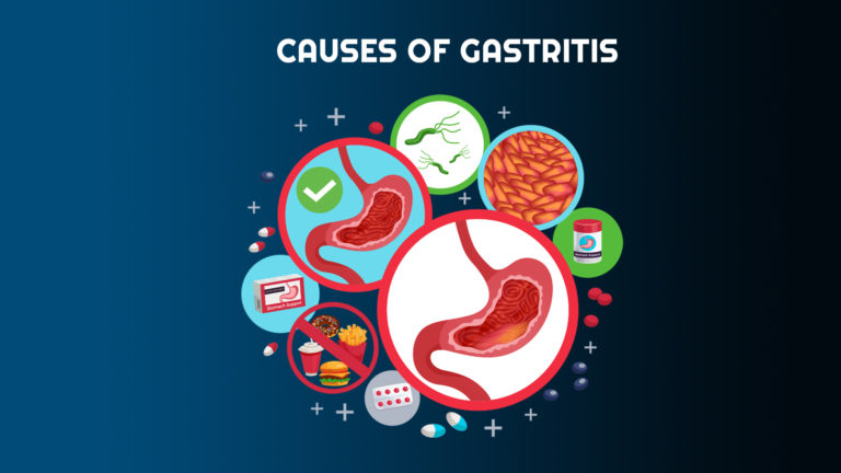 Gastritis-Causes, Treatment And Diagnosis – NutritionFact.in