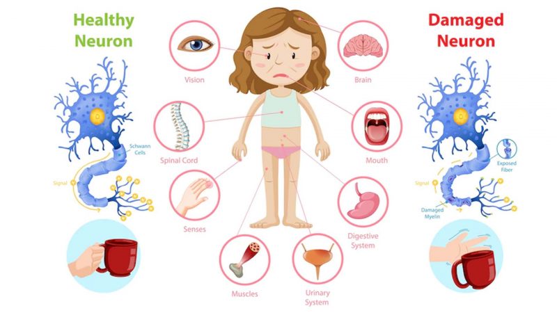 Multiple Sclerosis: Symptoms, Causes, Diagnosis, Treatment and Risk ...