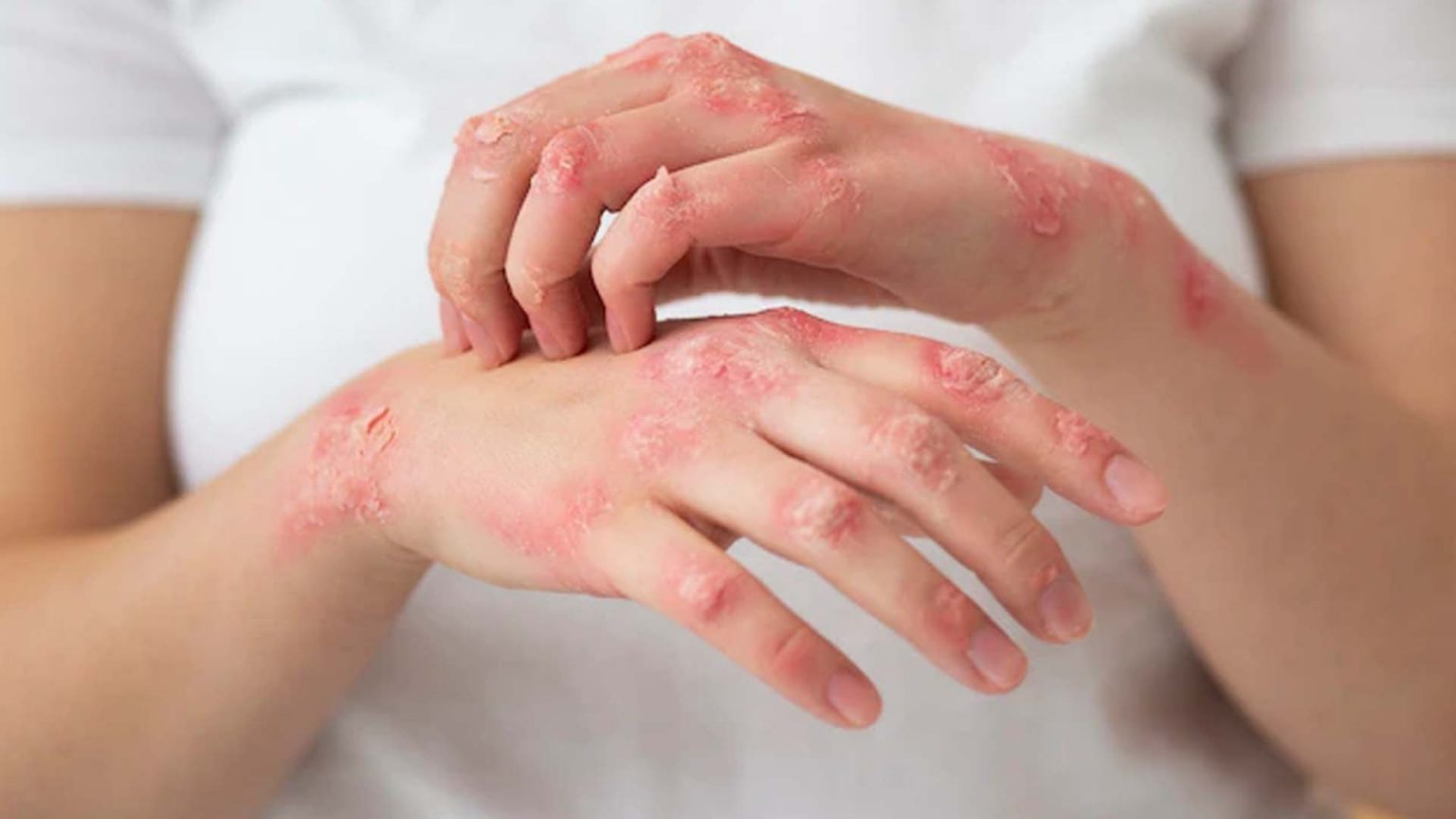 Skin Diseases: Types, Symptoms, Diagnosis, Treatment and Diet ...