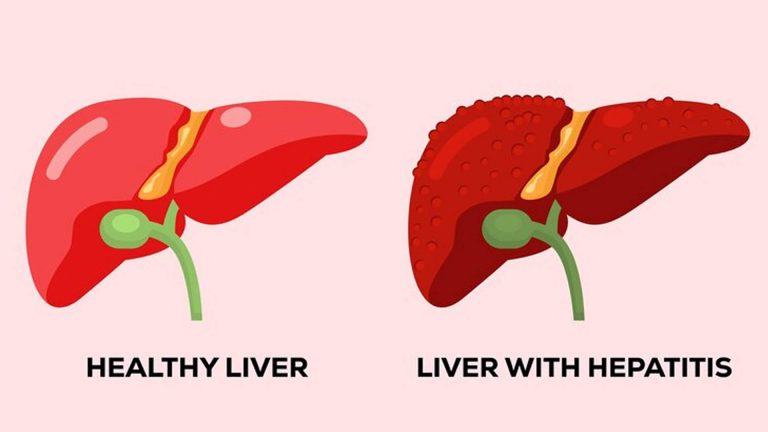 Liver Disease: Diagnosis, Treatment and Prevention – NutritionFact.in