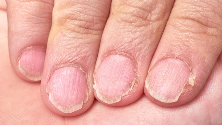 Calcium Deficiency (Hypocalcemia) – NutritionFact.in