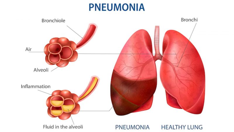 Pneumonia: Symptoms, Causes, Treatment and Diet – NutritionFact.in