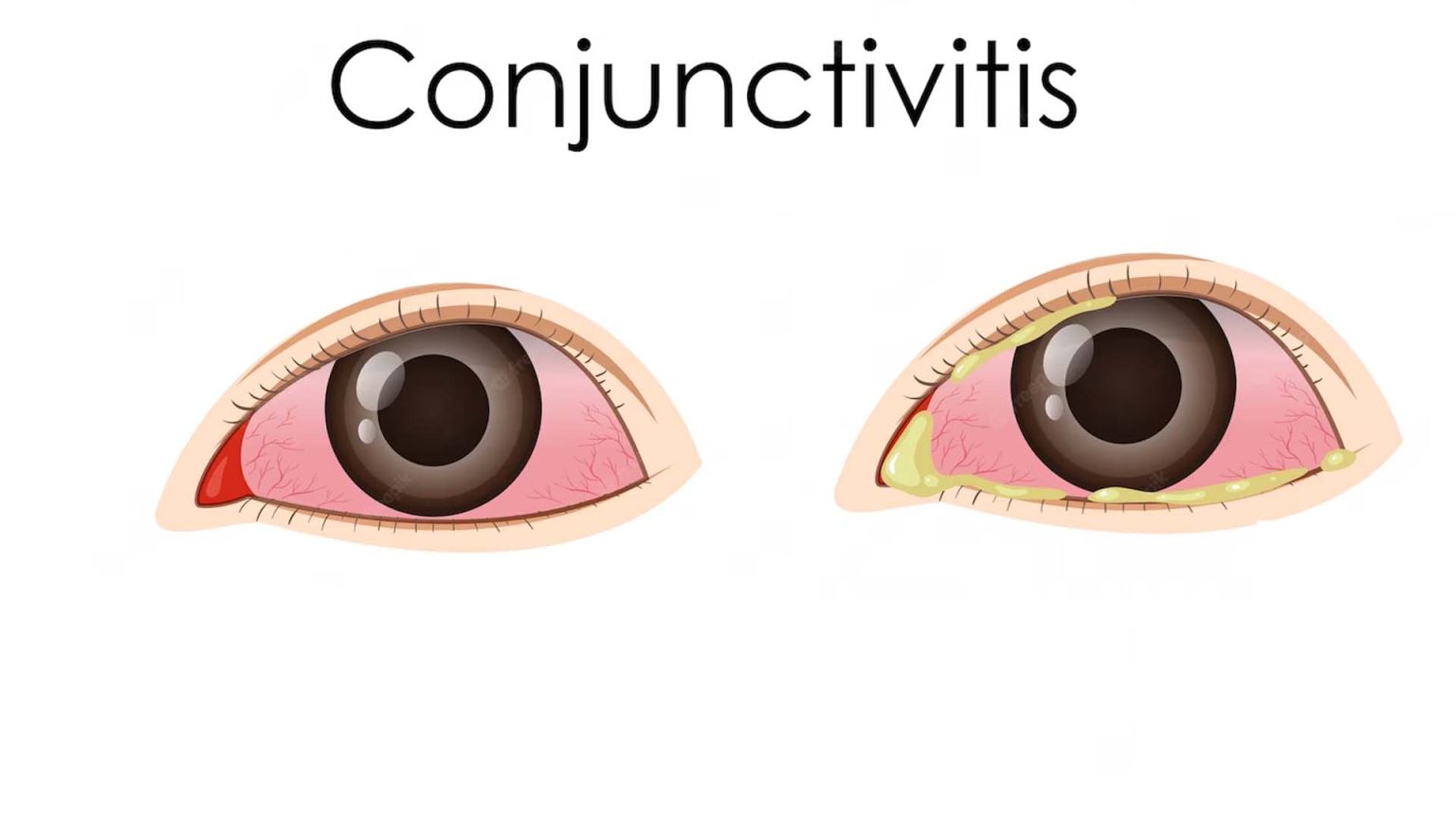 What Causes Conjunctivitis? – NutritionFact.in