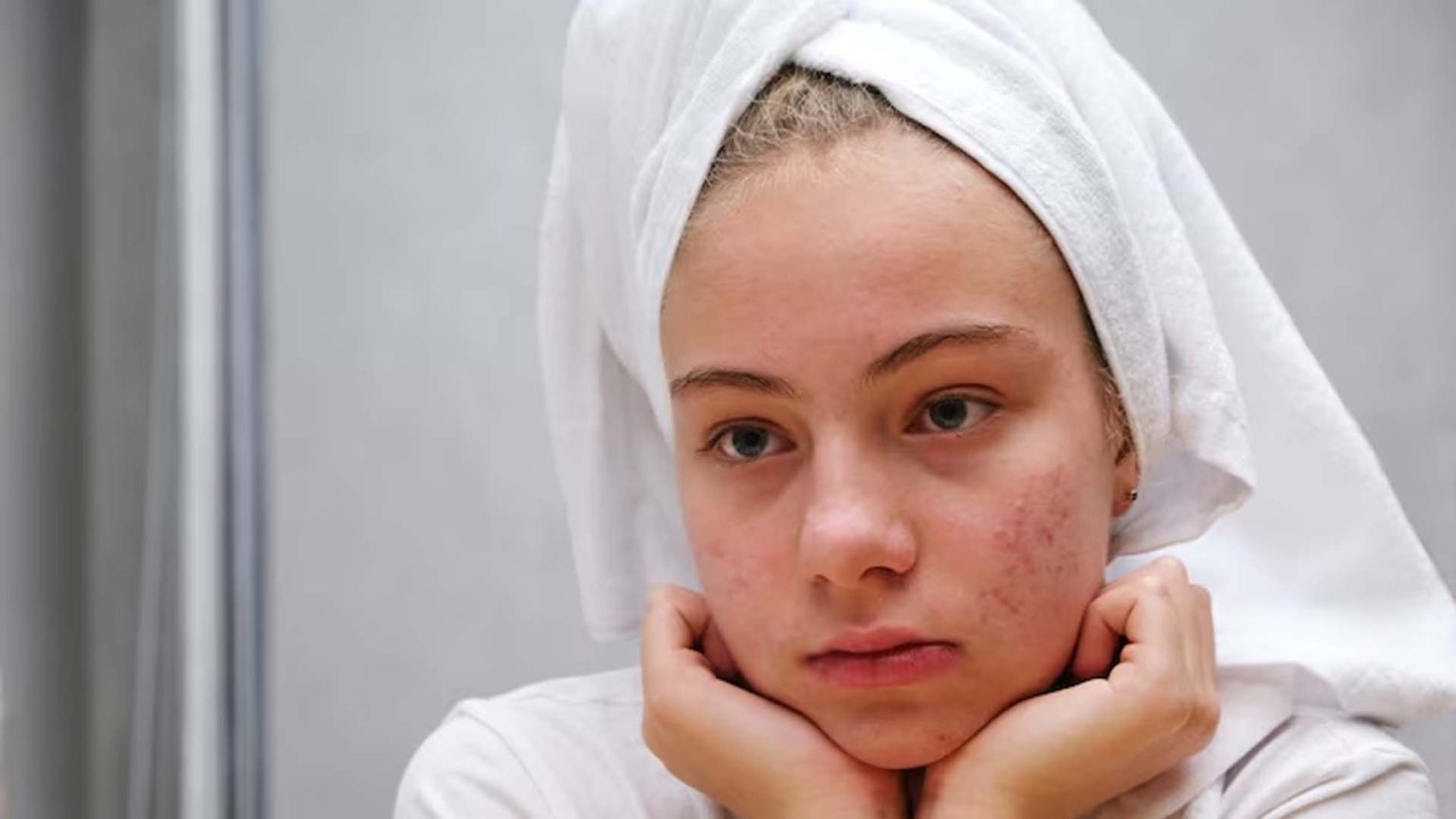 What Causes Pimples on Face? – NutritionFact.in