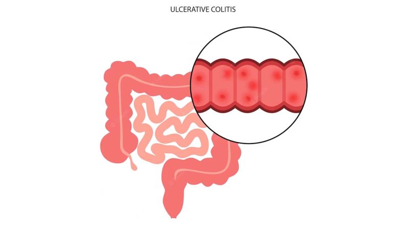 What Causes Colitis? – NutritionFact.in