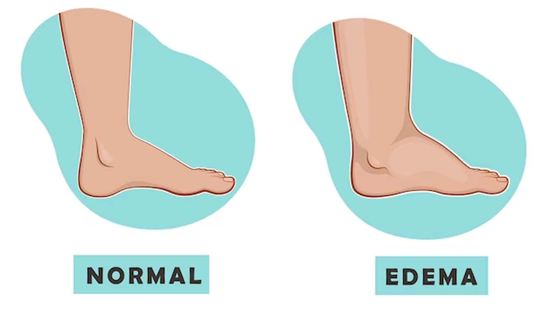 What Causes Edema In Legs NutritionFact in What Causes Edema In Legs NutritionFact in