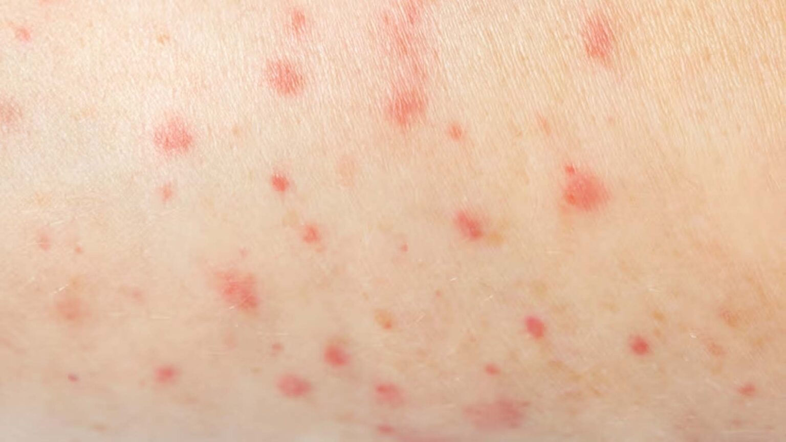 What Causes Red Spots On Skin NutritionFact in