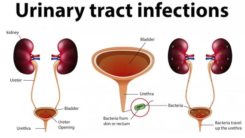 Does UTI Cause Stomach Pain? – NutritionFact.in