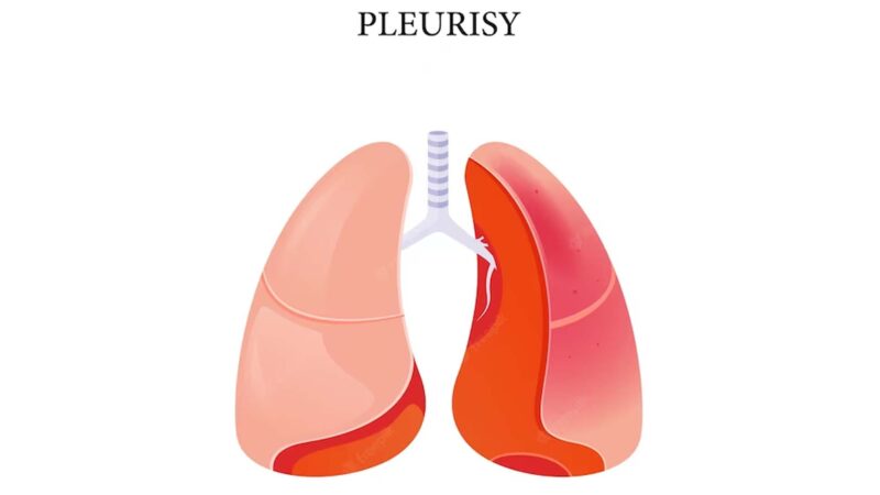 What Causes Pleurisy? – NutritionFact.in