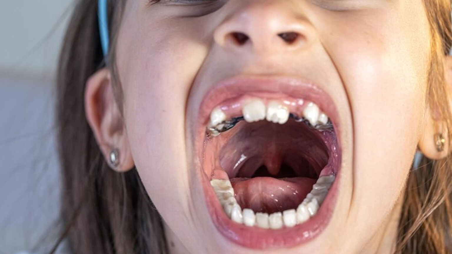 What are the Causes and Symptoms of Scurvy? – NutritionFact.in