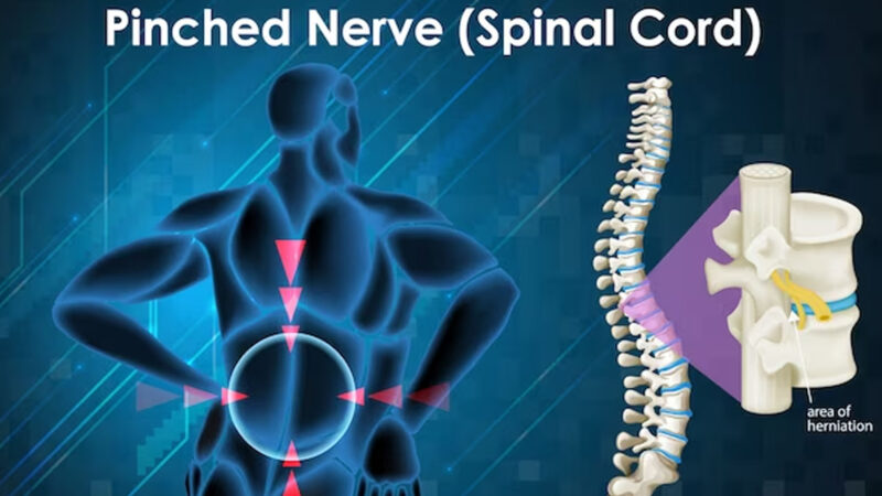 What are the Symptoms of Nerve Root Compression? – NutritionFact.in