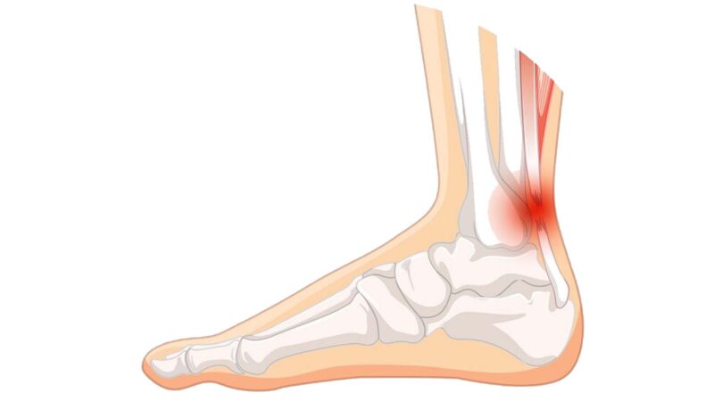 What Causes Ankles to Swell? – NutritionFact.in