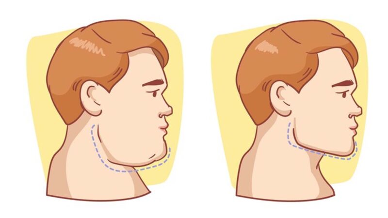 What Can Cause Swelling of the Face? – NutritionFact.in