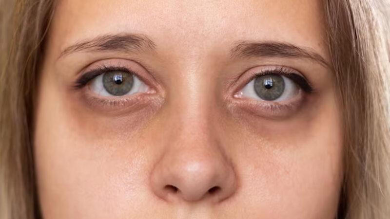 What are Bulging Eyes a Symptom of? – NutritionFact.in