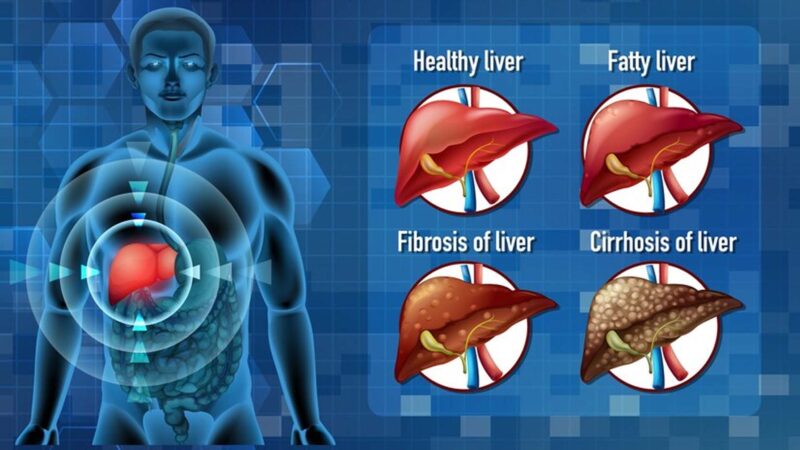 What Causes Liver Problems? – NutritionFact.in