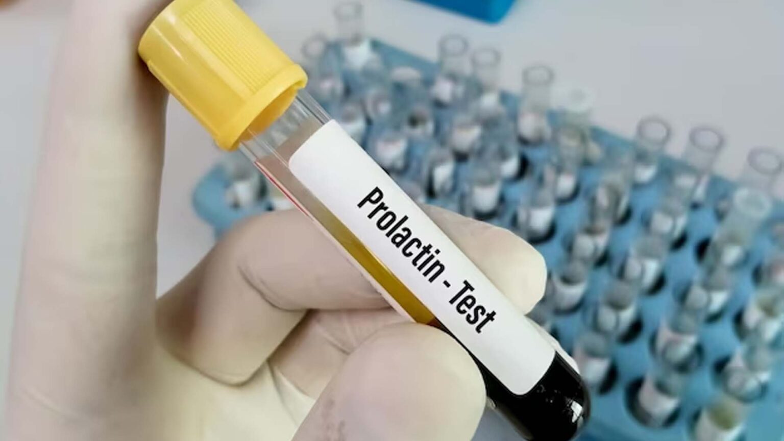 What Causes High Prolactin? – NutritionFact.in