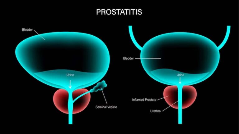 Can Prostatitis Cause Bowel Problems? – NutritionFact.in