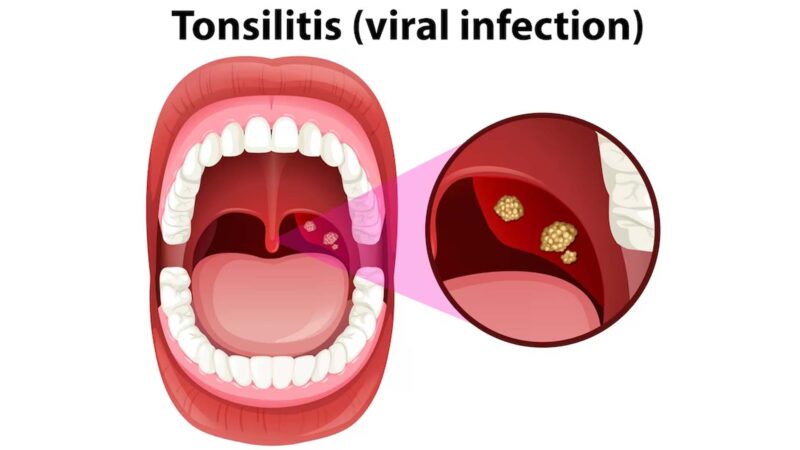 Can Tonsillitis cause a cough? – NutritionFact.in