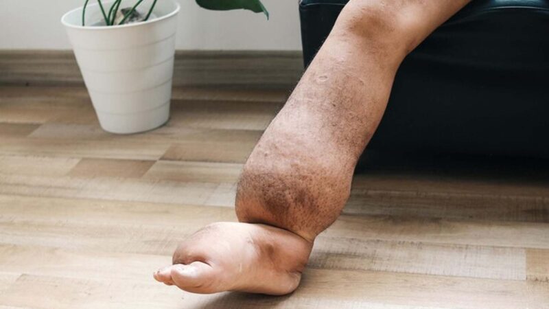 What Causes Elephantiasis of the Legs? – NutritionFact.in