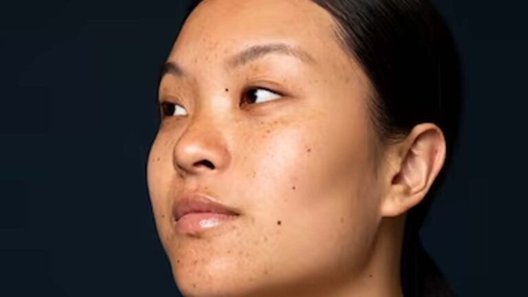 What Causes Moles on Face? – NutritionFact.in