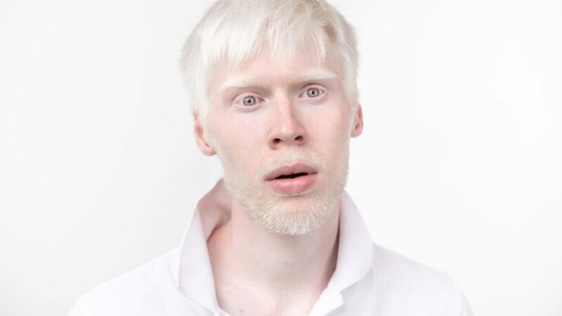 What Causes White Facial Hair? – NutritionFact.in